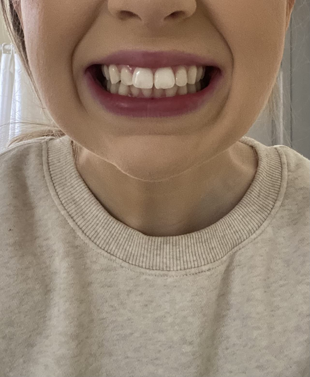 My 4 Weeks Experience Using Moon Teeth Whitening Pen by Kendall Jenner ...